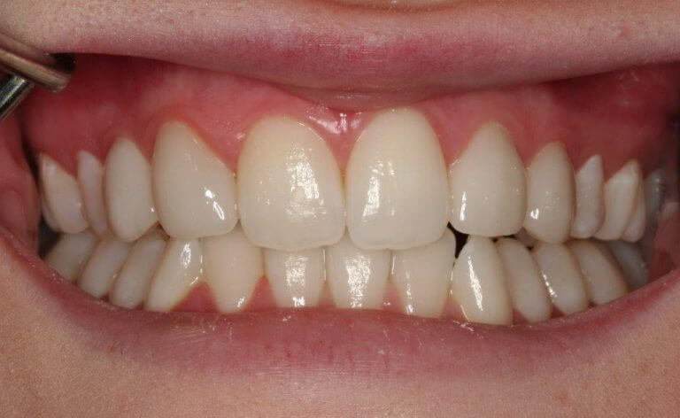 Natural Looking Veneers - Smile Makeover - Stricklands