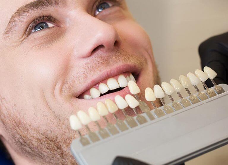 Natural Looking Veneers | Smile Makeover | Stricklands