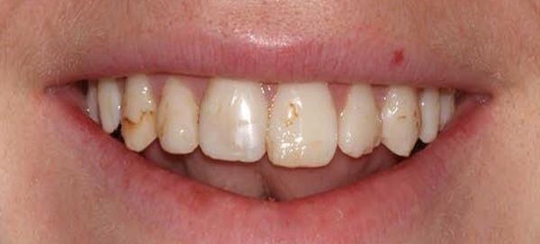 Smile Gallery | Smile Whitening | Stricklands Dental Fitness Centre